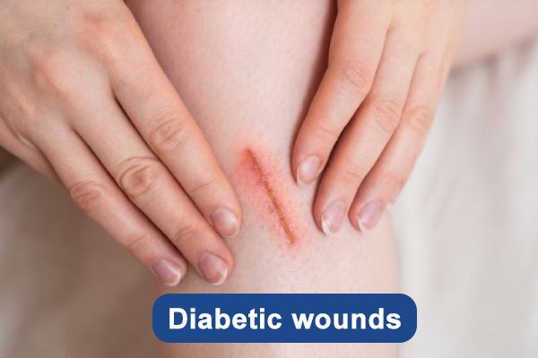 What You Need to Know About Diabetic Wounds